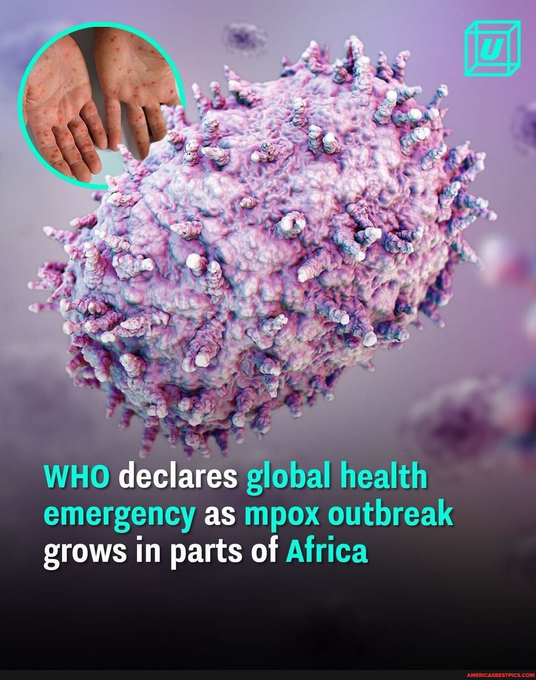 The World Health Organization WHO has labeled the mpox outbreak in ...