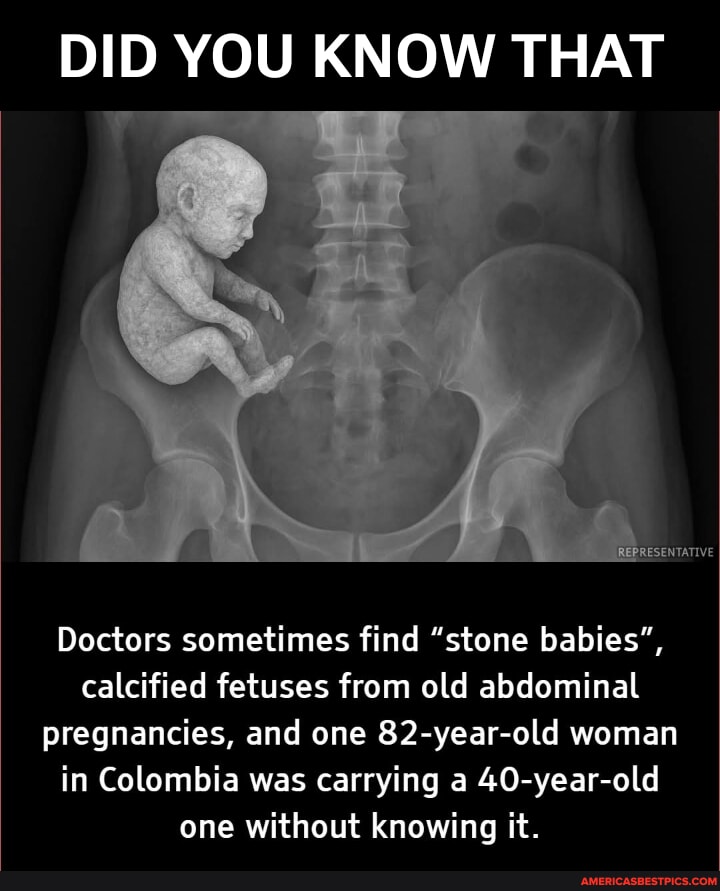 DID YOU KNOW THAT Doctors sometimes find "stone babies", calcified ...