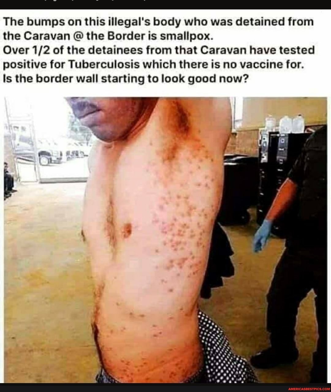 The bumps on this illegal's body who was detained from the Caravan ...